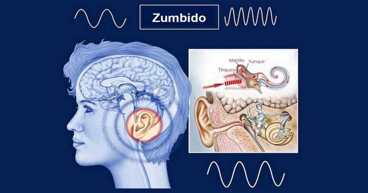 Os 5 melhores remédios caseiros para zumbido no ouvido - Assuntos de ...